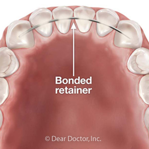 A Bonded Retainer Might be a Better Choice After Braces